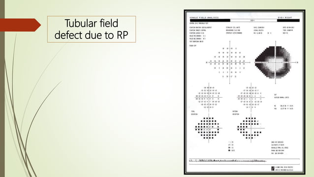 Perimetry & Humprey visual field assay (HVFA) | PPTX | Eye and Vision ...