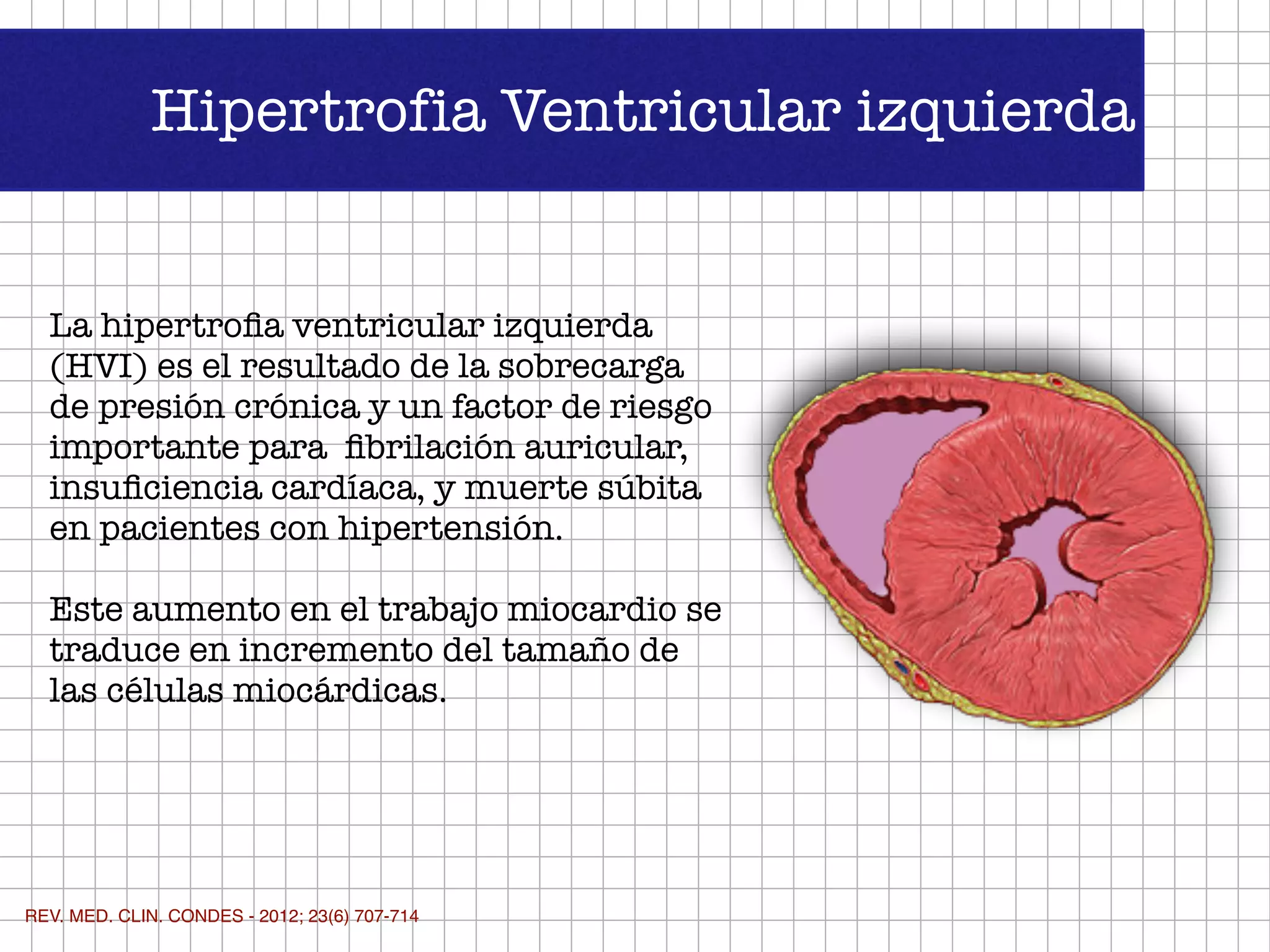 Hipertrofia ventricular izq | PDF