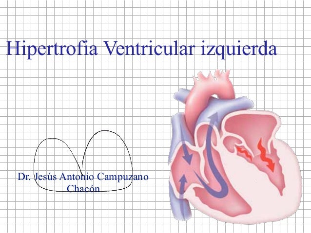 Hipertrofia ventricular izq