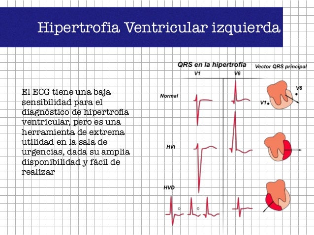 Hipertrofia ventricular izq