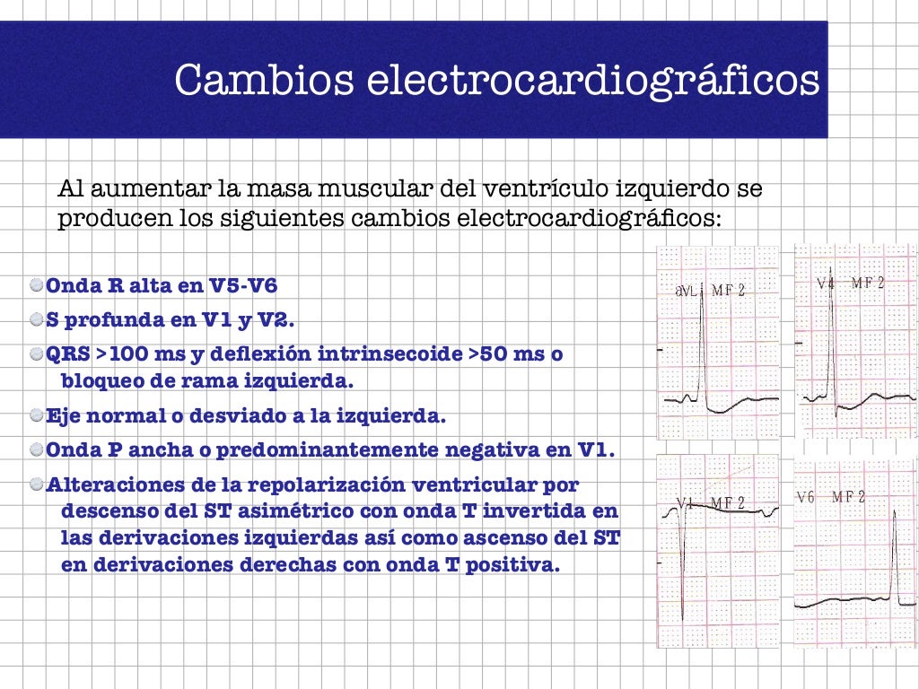 Hipertrofia ventricular izq