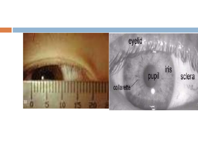 Hvid | PPTX | Eye and Vision Conditions | Diseases and Conditions