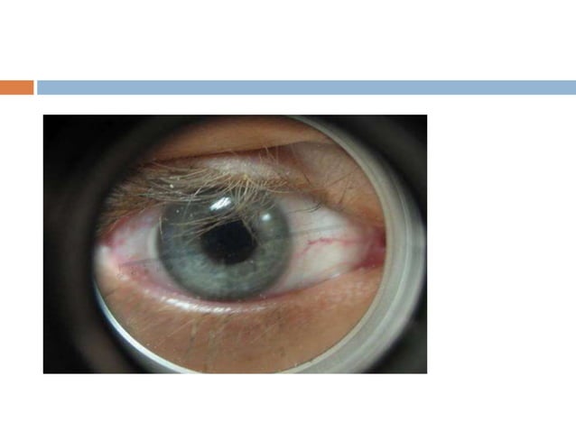 Hvid | PPTX | Eye and Vision Conditions | Diseases and Conditions