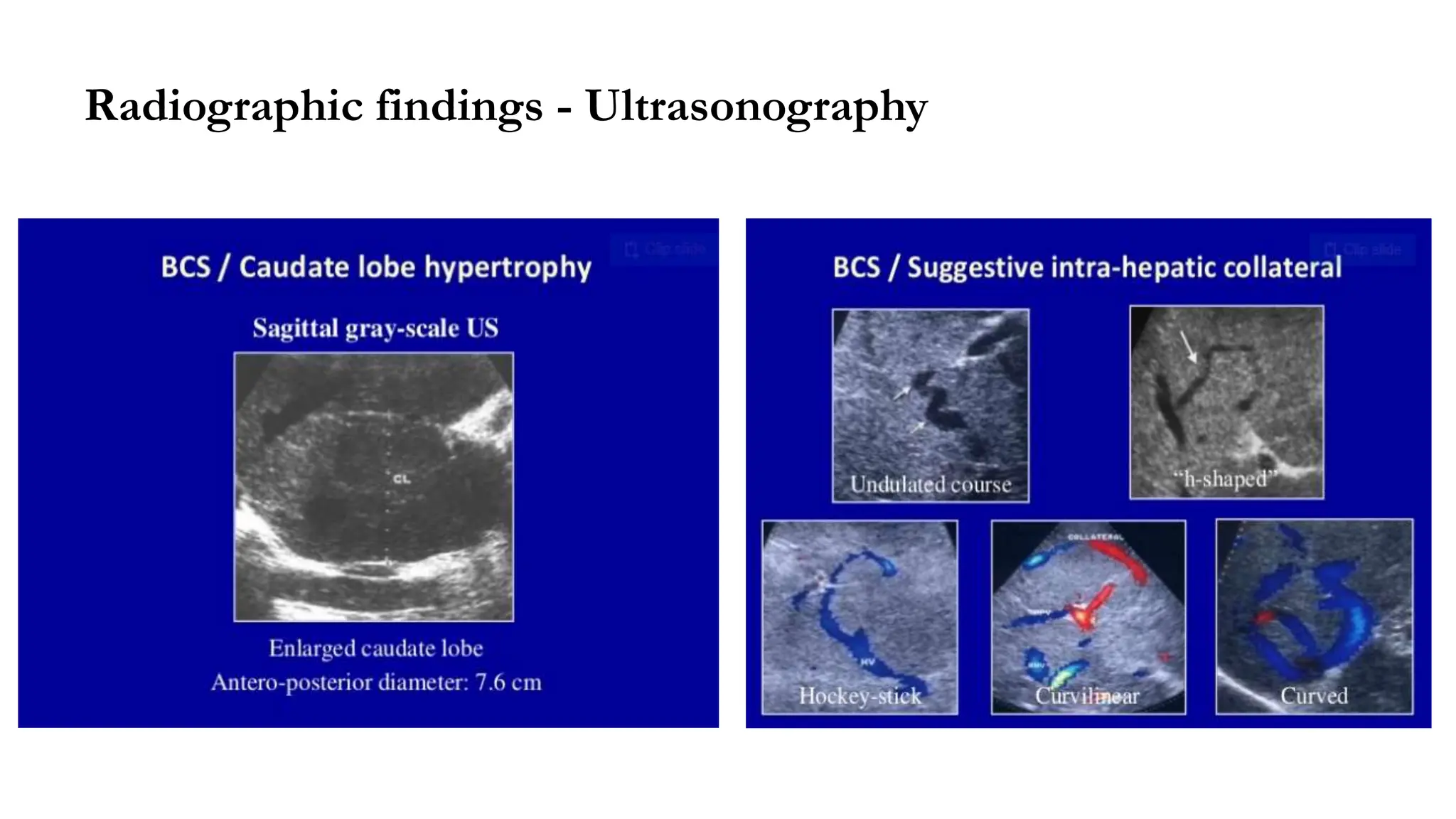 HEPATIC VENOUS OUTFLOW TRACT OBSTRUCTION/BUD-CHAIRI SYNDROME (BCS/HVOTO ...