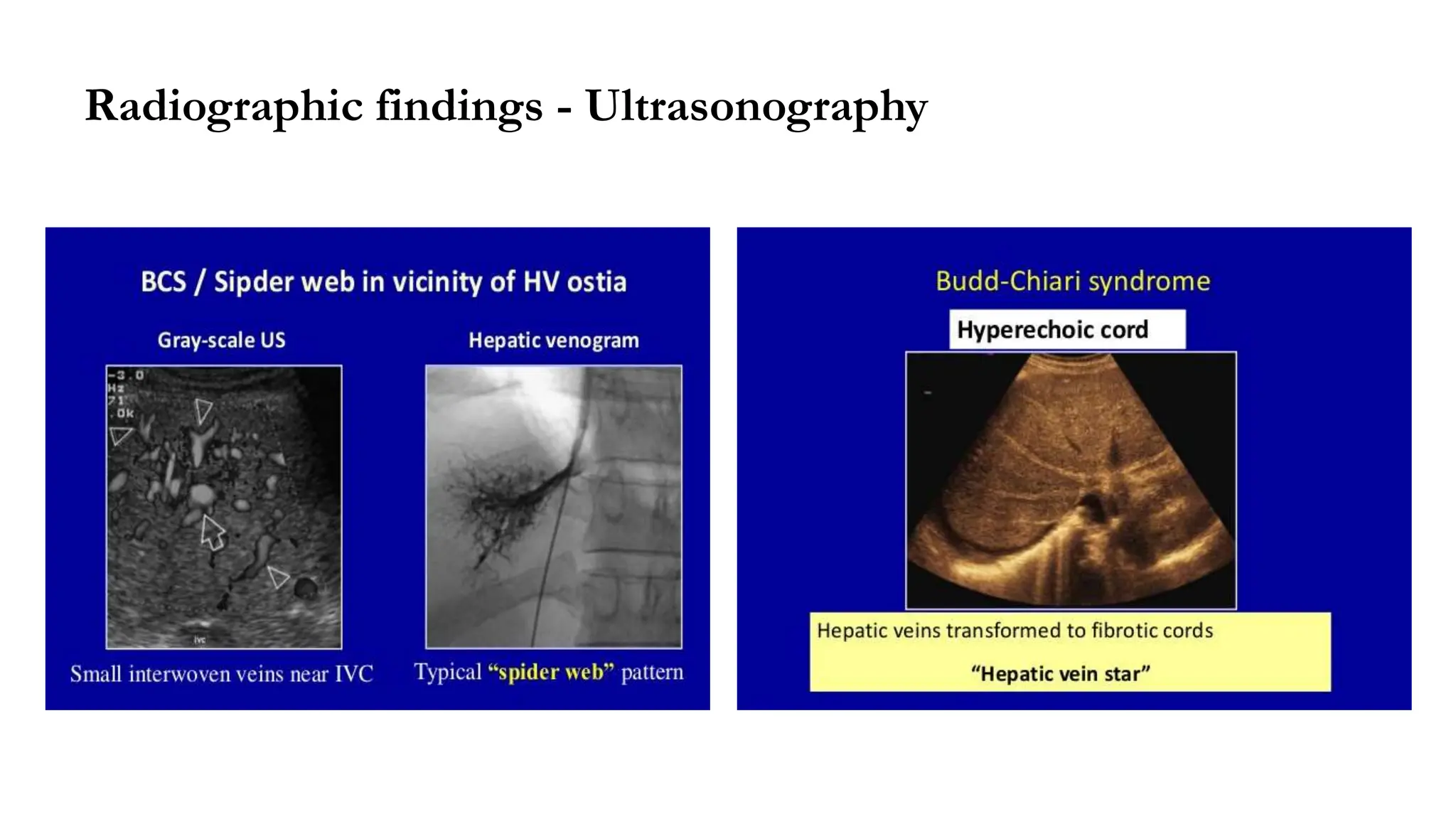 HEPATIC VENOUS OUTFLOW TRACT OBSTRUCTION/BUD-CHAIRI SYNDROME (BCS/HVOTO ...