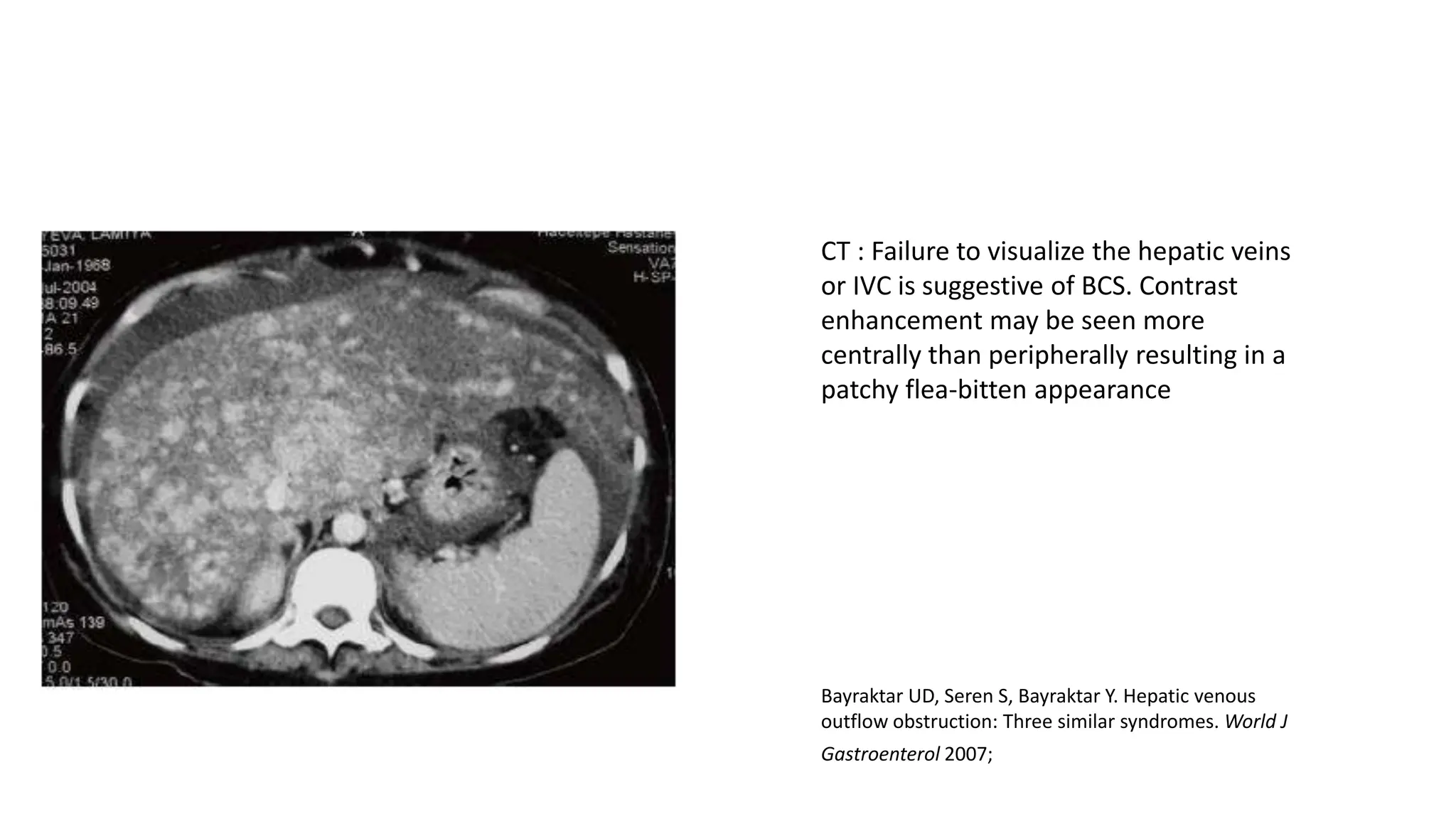 HEPATIC VENOUS OUTFLOW TRACT OBSTRUCTION/BUD-CHAIRI SYNDROME (BCS/HVOTO ...