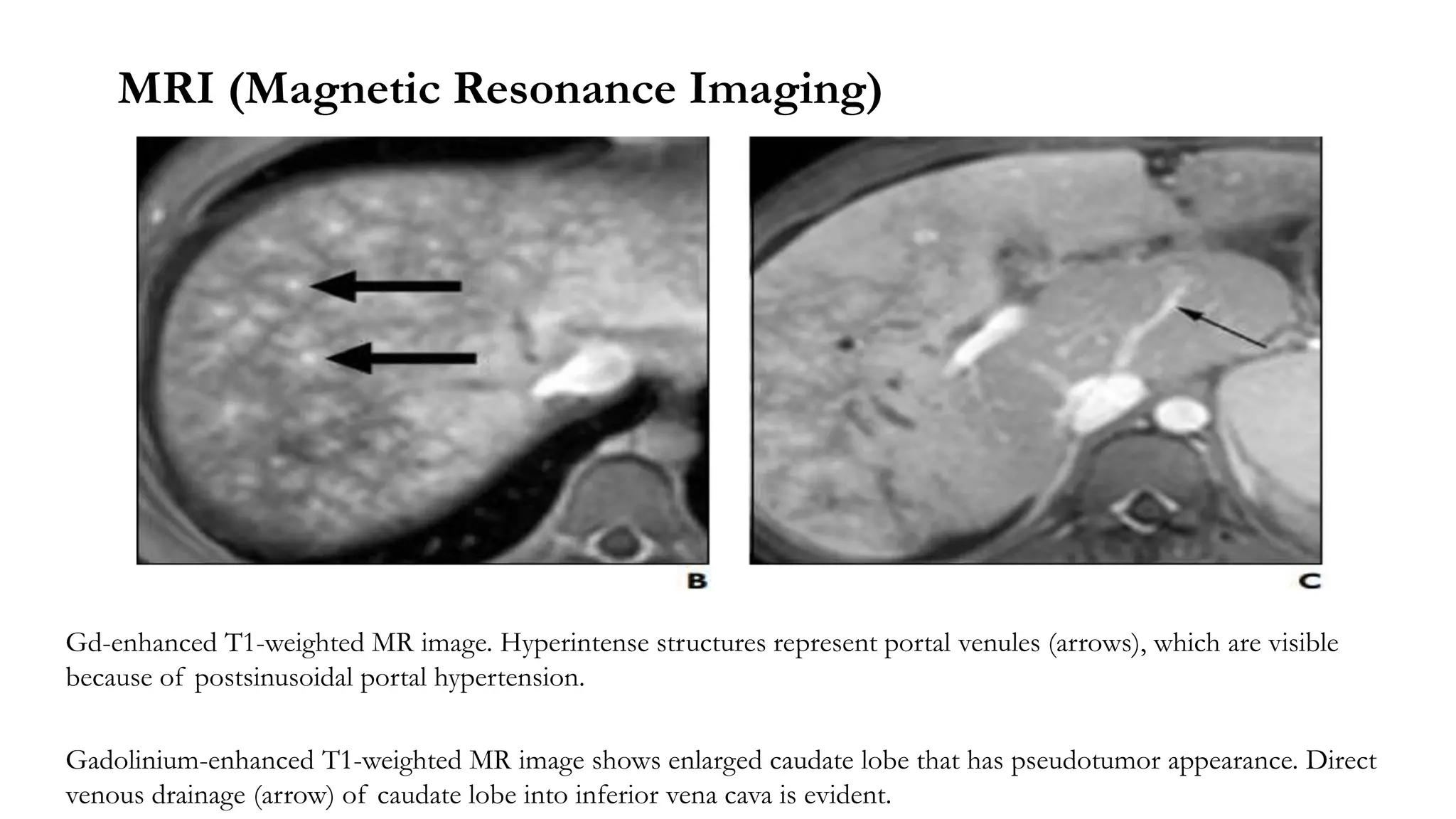 HEPATIC VENOUS OUTFLOW TRACT OBSTRUCTION/BUD-CHAIRI SYNDROME (BCS/HVOTO ...