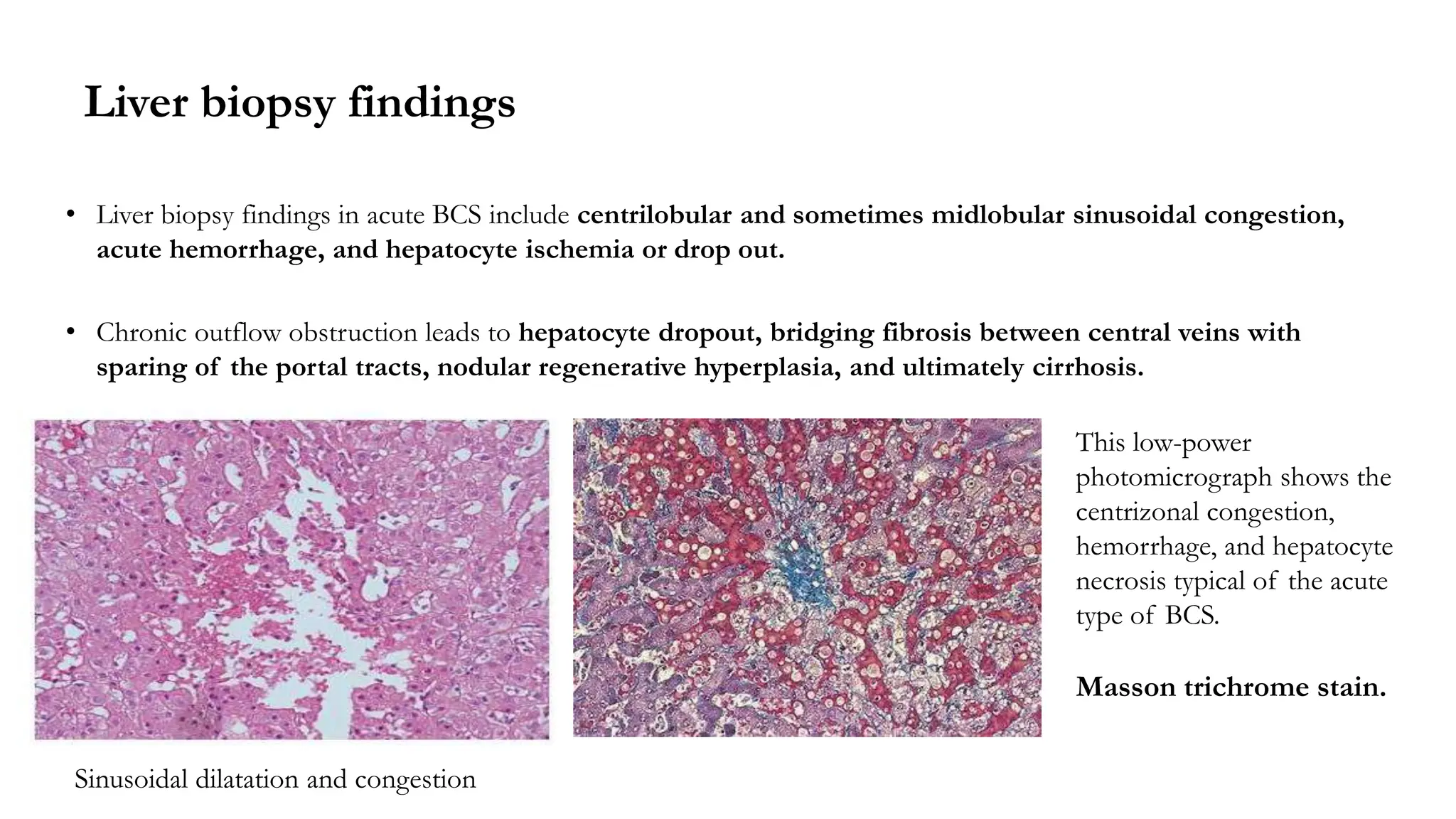 HEPATIC VENOUS OUTFLOW TRACT OBSTRUCTION/BUD-CHAIRI SYNDROME (BCS/HVOTO ...