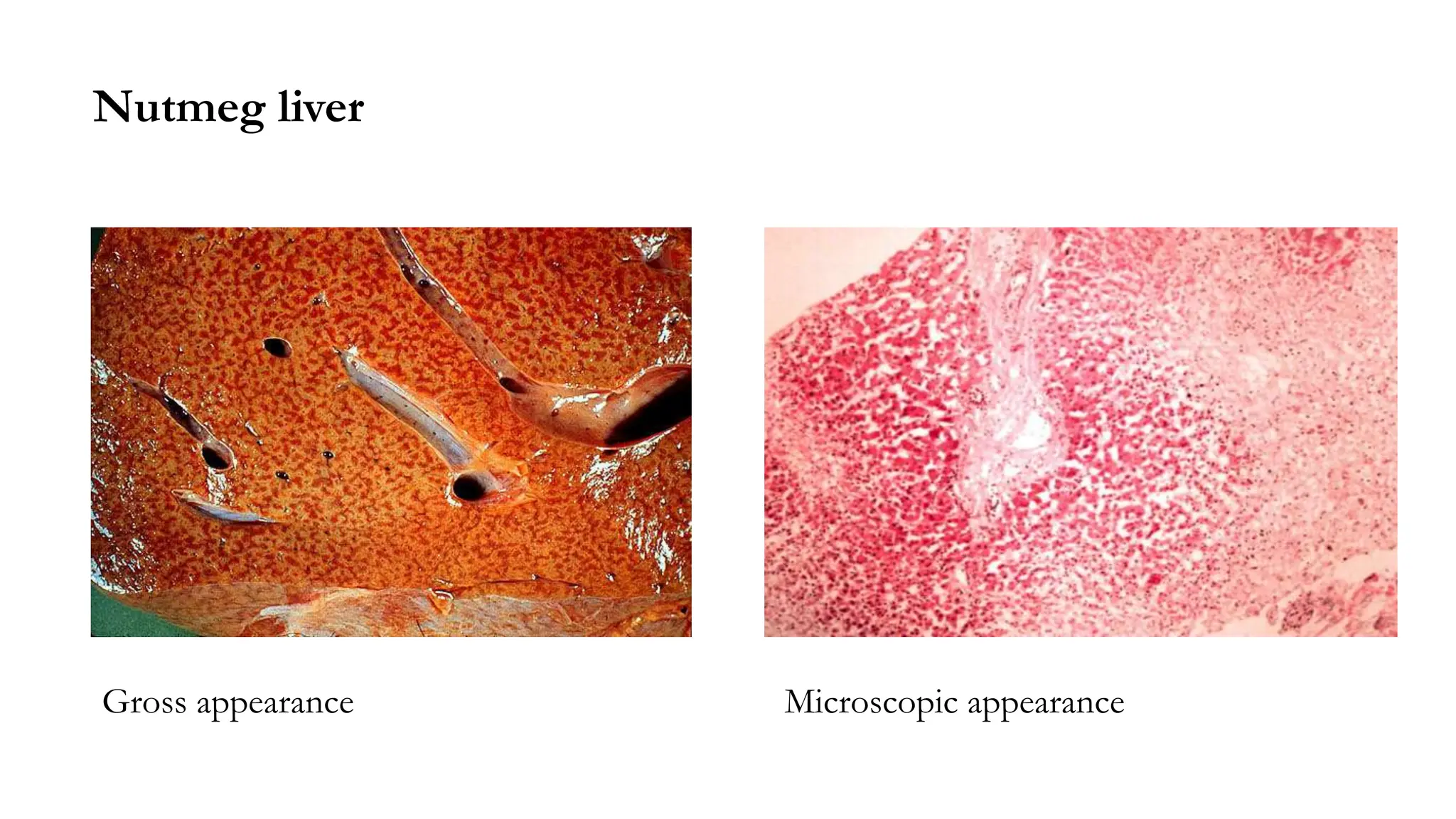 HEPATIC VENOUS OUTFLOW TRACT OBSTRUCTION/BUD-CHAIRI SYNDROME (BCS/HVOTO ...