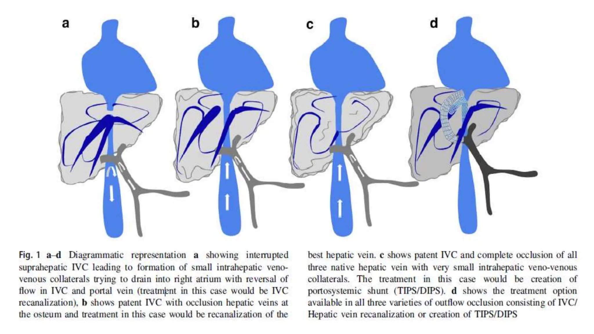 HEPATIC VENOUS OUTFLOW TRACT OBSTRUCTION/BUD-CHAIRI SYNDROME (BCS/HVOTO ...