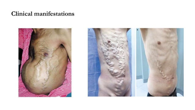 HEPATIC VENOUS OUTFLOW TRACT OBSTRUCTION/BUD-CHAIRI SYNDROME (BCS/HVOTO ...