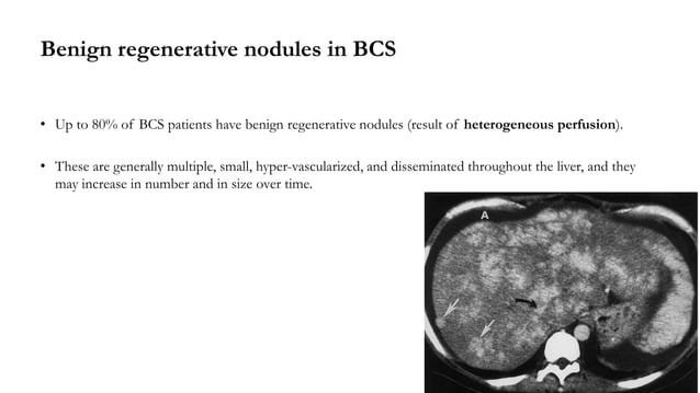 HEPATIC VENOUS OUTFLOW TRACT OBSTRUCTION/BUD-CHAIRI SYNDROME (BCS/HVOTO ...