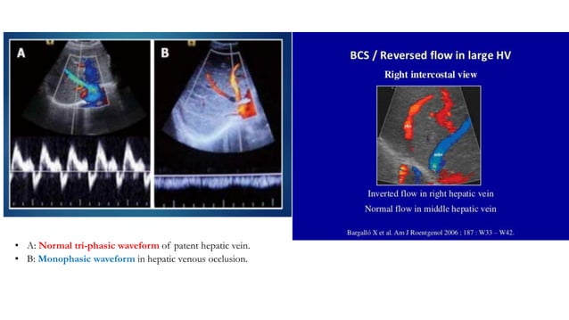 HEPATIC VENOUS OUTFLOW TRACT OBSTRUCTION/BUD-CHAIRI SYNDROME (BCS/HVOTO ...