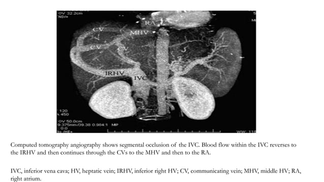 HEPATIC VENOUS OUTFLOW TRACT OBSTRUCTION/BUD-CHAIRI SYNDROME (BCS/HVOTO ...