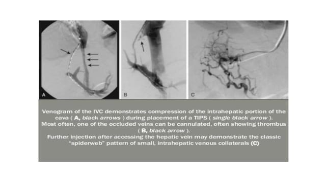 HEPATIC VENOUS OUTFLOW TRACT OBSTRUCTION/BUD-CHAIRI SYNDROME (BCS/HVOTO ...