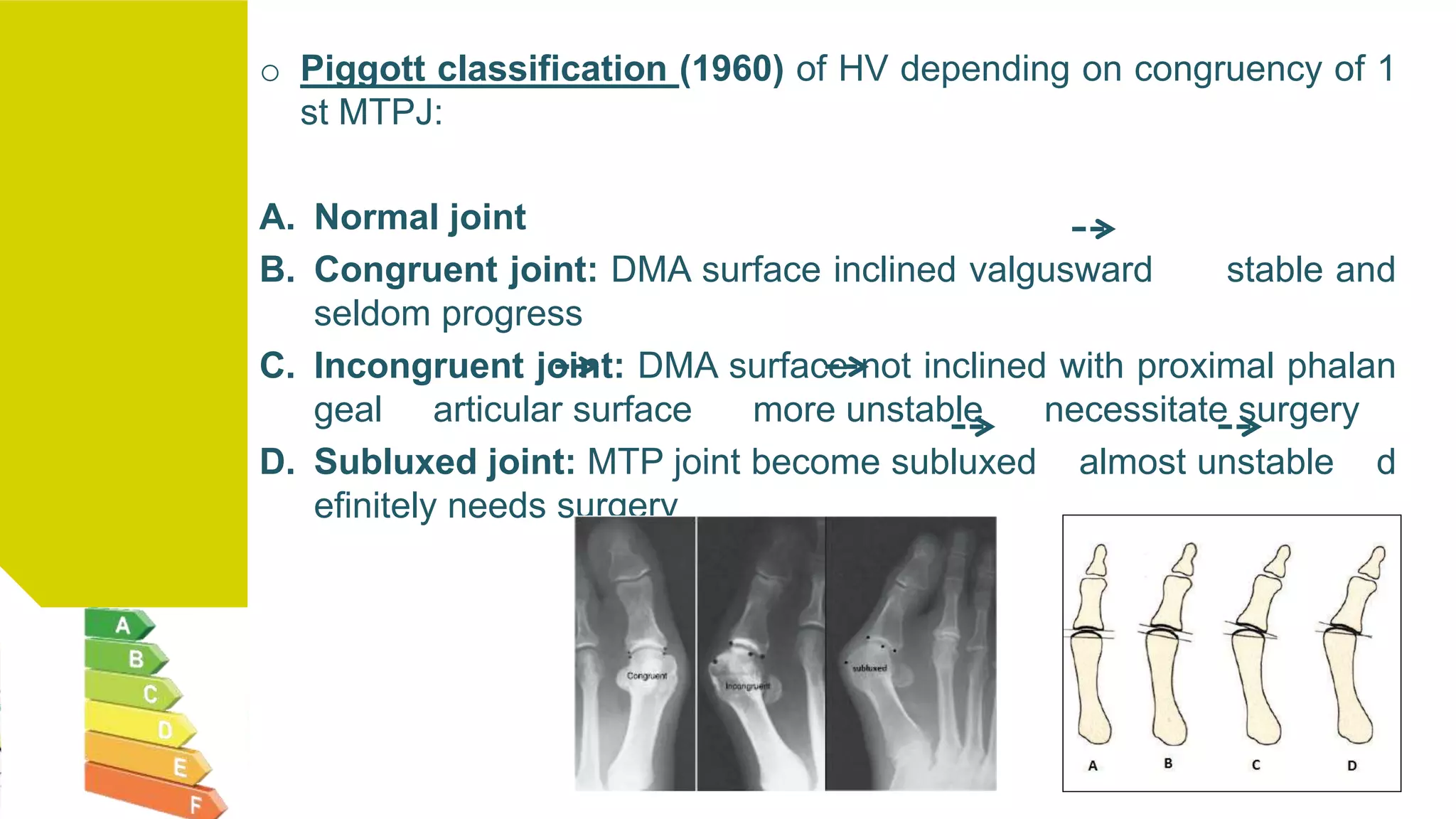 Outcome of Mitchell's procedure in the treatment of hallux valgus | PPT