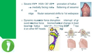 Outcome of Mitchell's procedure in the treatment of hallux valgus | PPTX