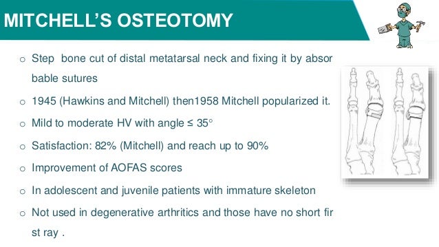 Outcome of Mitchell's procedure in the treatment of hallux valgus