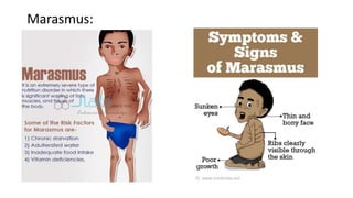 Malnutrition.pptx