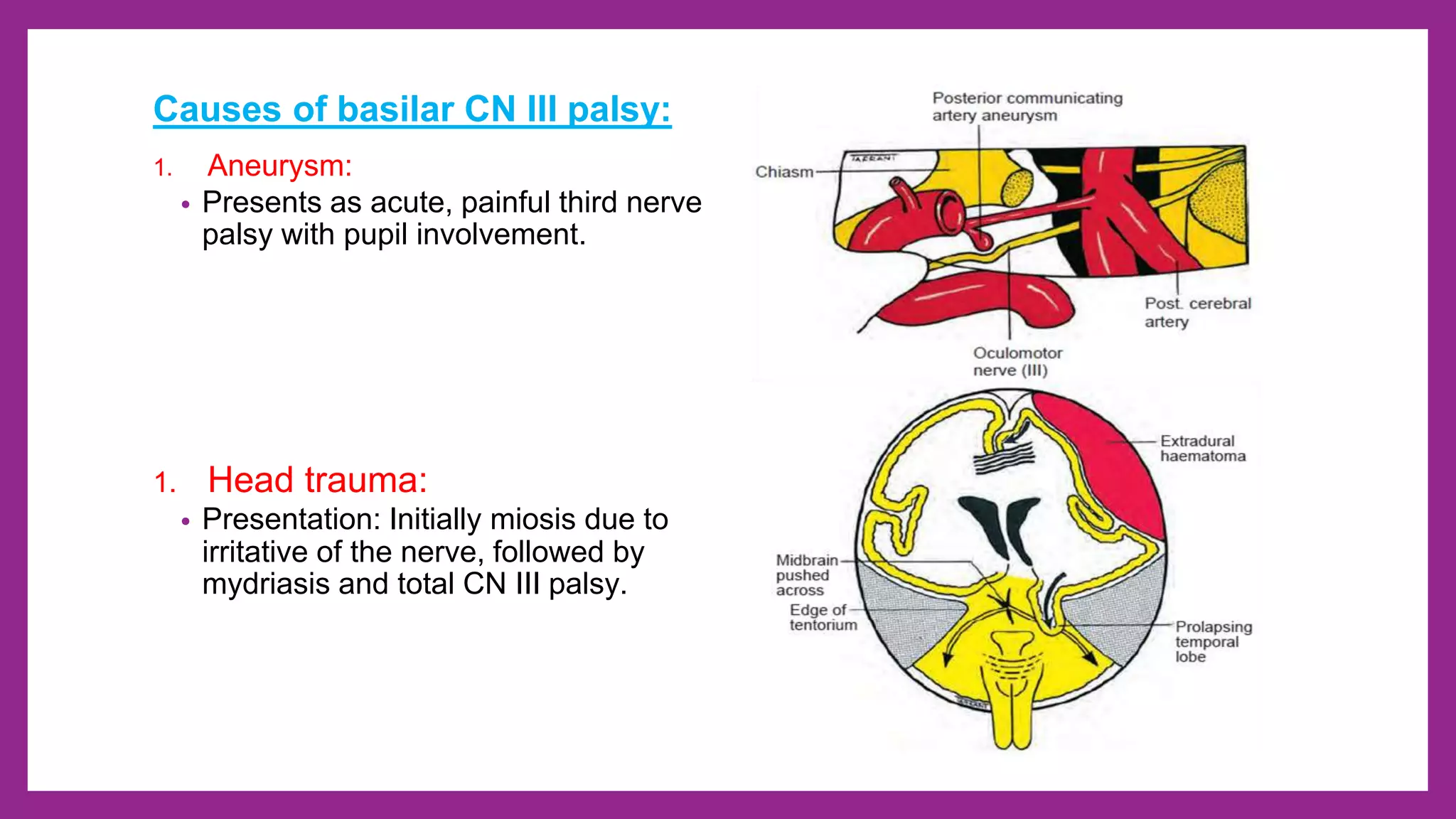 Ocular nerve palsy - 3rd, 4th and 6th cranial nerve palsy | PPTX