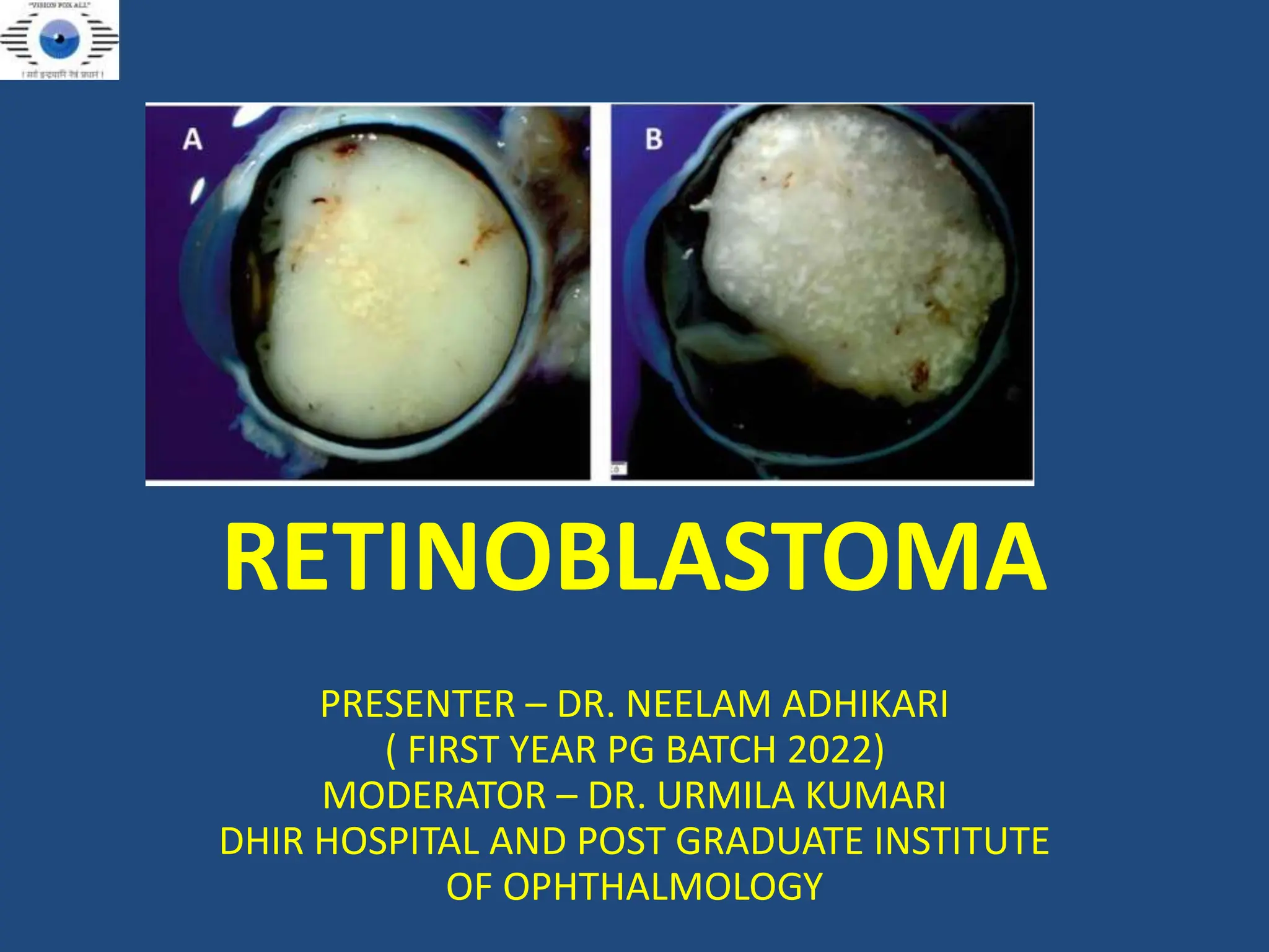 RETINOBLASTOMA presentation dhir hospital bhiwani.pptx