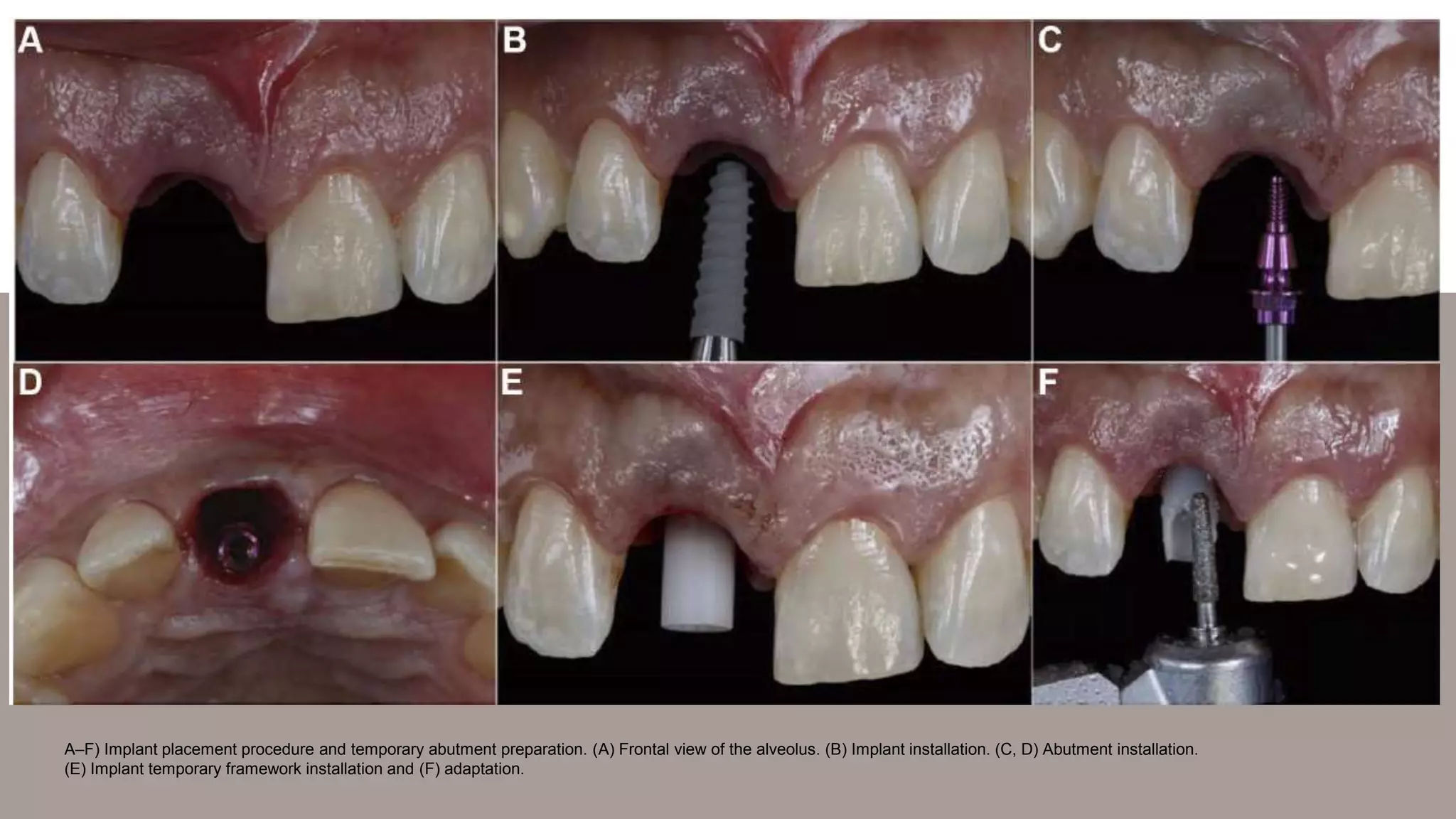 hybrid abutments.pptx