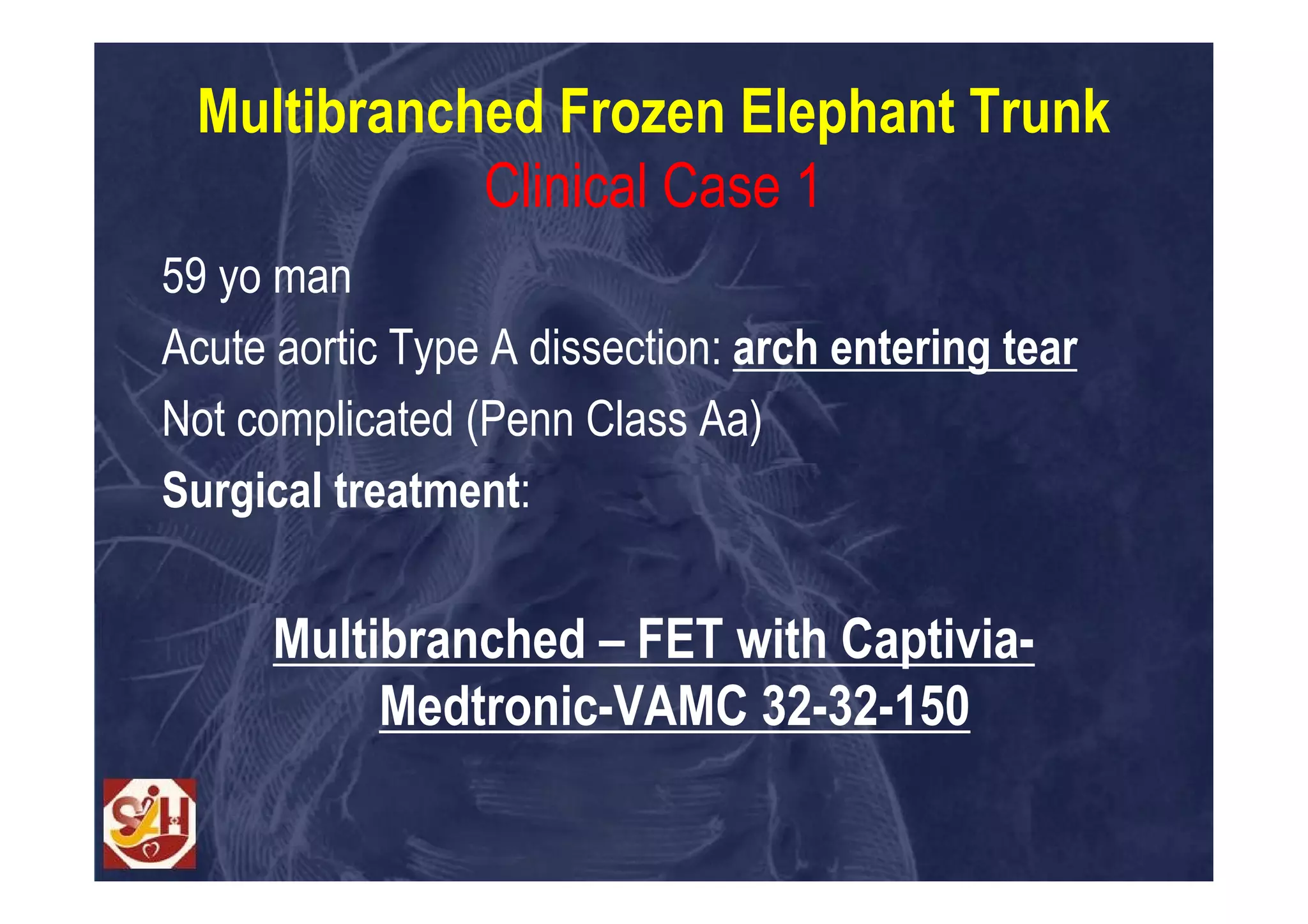 Hybrid approach for type a aortic dissection | PDF