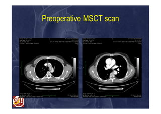 Hybrid approach for type a aortic dissection | PDF