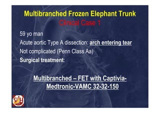 Hybrid approach for type a aortic dissection | PDF
