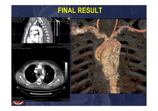 Hybrid approach for type a aortic dissection | PDF