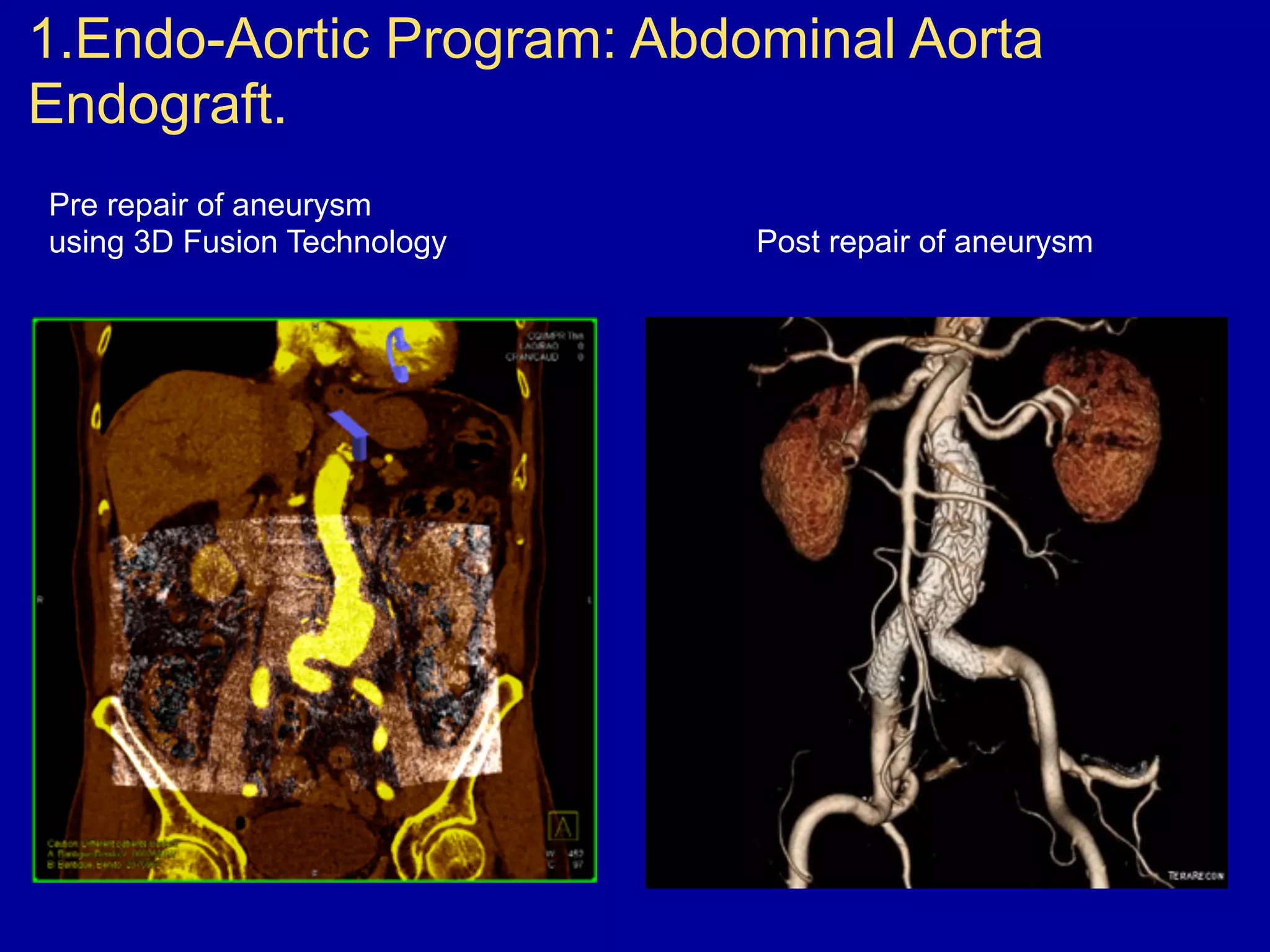 Hybrid cardiac surgery program | PDF