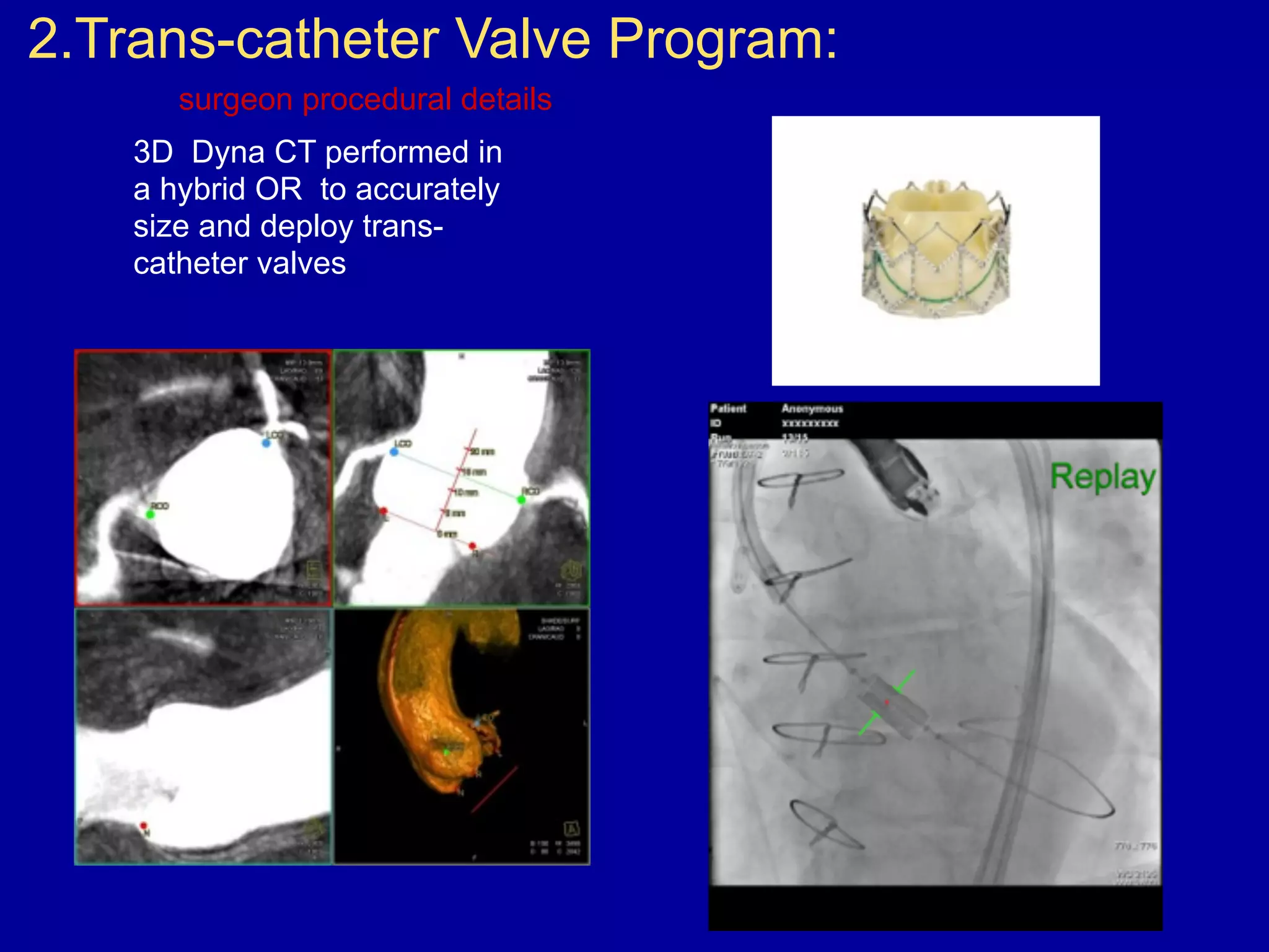 Hybrid cardiac surgery program | PDF