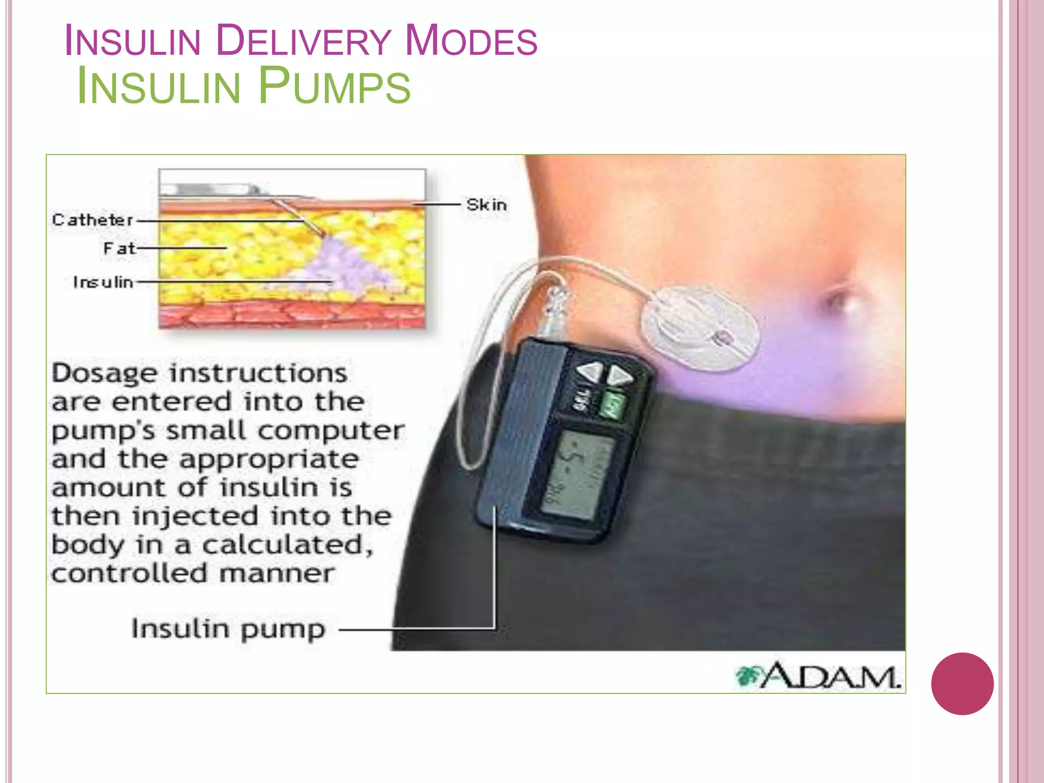 Hybrid closed loop insulin delivery system-Artificial Pancreas. | PPTX