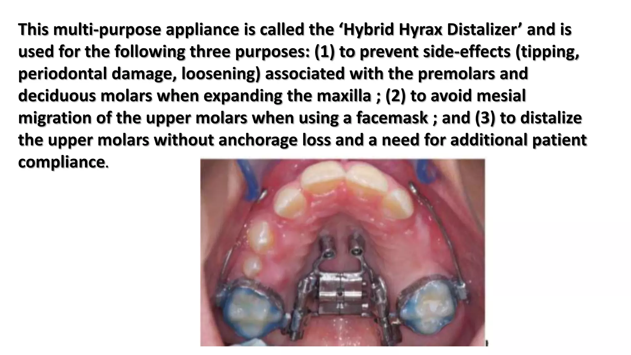 The Hybrid Hyrax Distalizer | PPTX