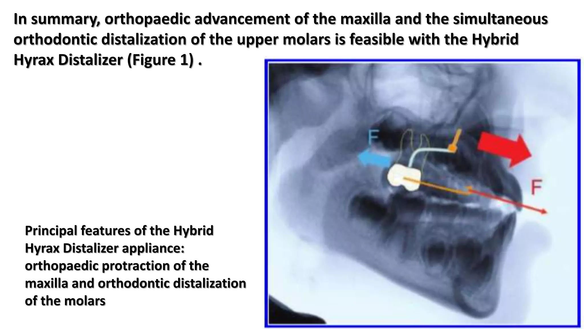 The Hybrid Hyrax Distalizer | PPTX