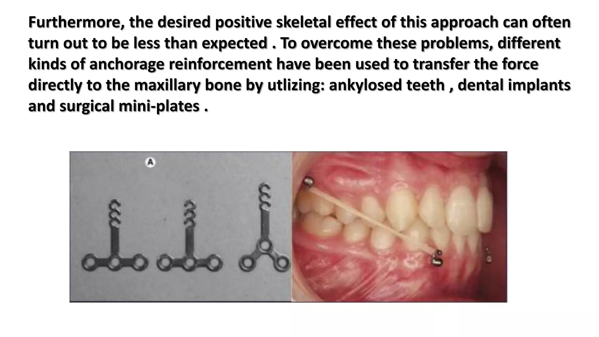 The Hybrid Hyrax Distalizer | PPTX