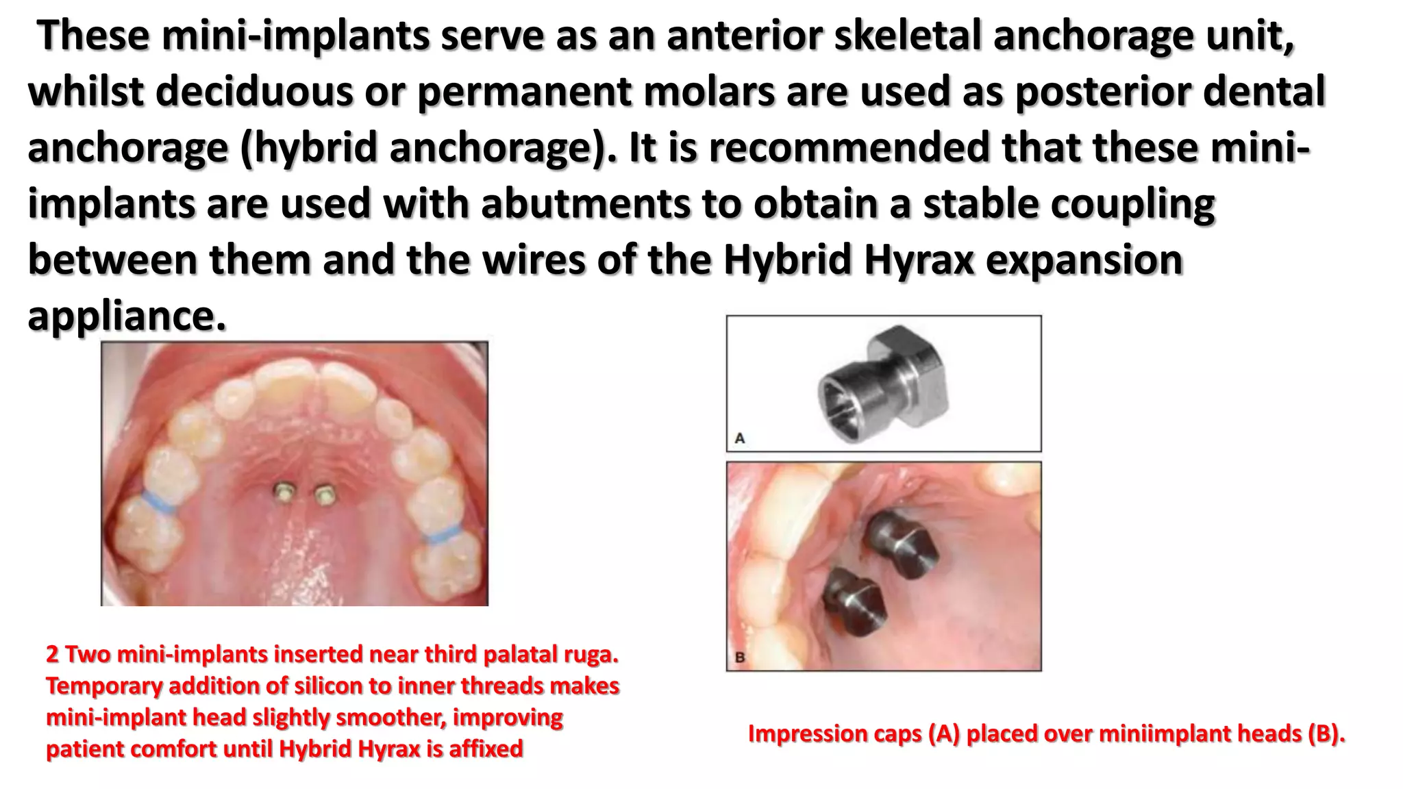 The Hybrid Hyrax Distalizer | PPTX