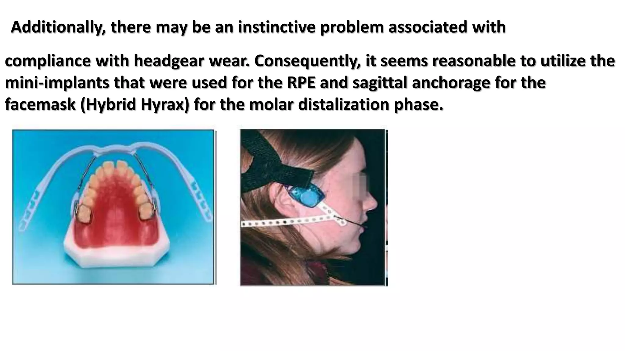 The Hybrid Hyrax Distalizer | PPTX