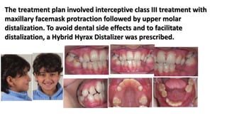 The Hybrid Hyrax Distalizer | PPTX