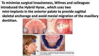 The Hybrid Hyrax Distalizer | PPTX
