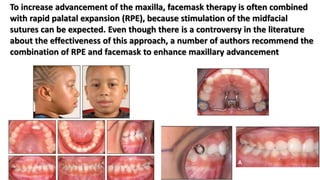 The Hybrid Hyrax Distalizer | PPTX