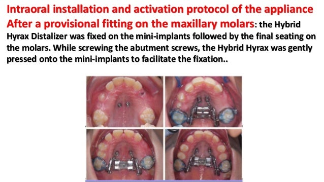 The Hybrid Hyrax Distalizer