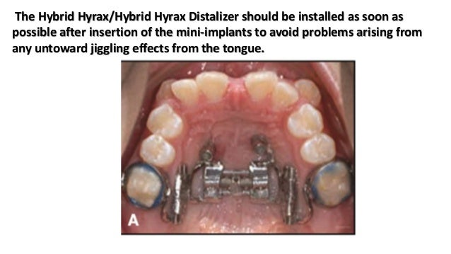 The Hybrid Hyrax Distalizer
