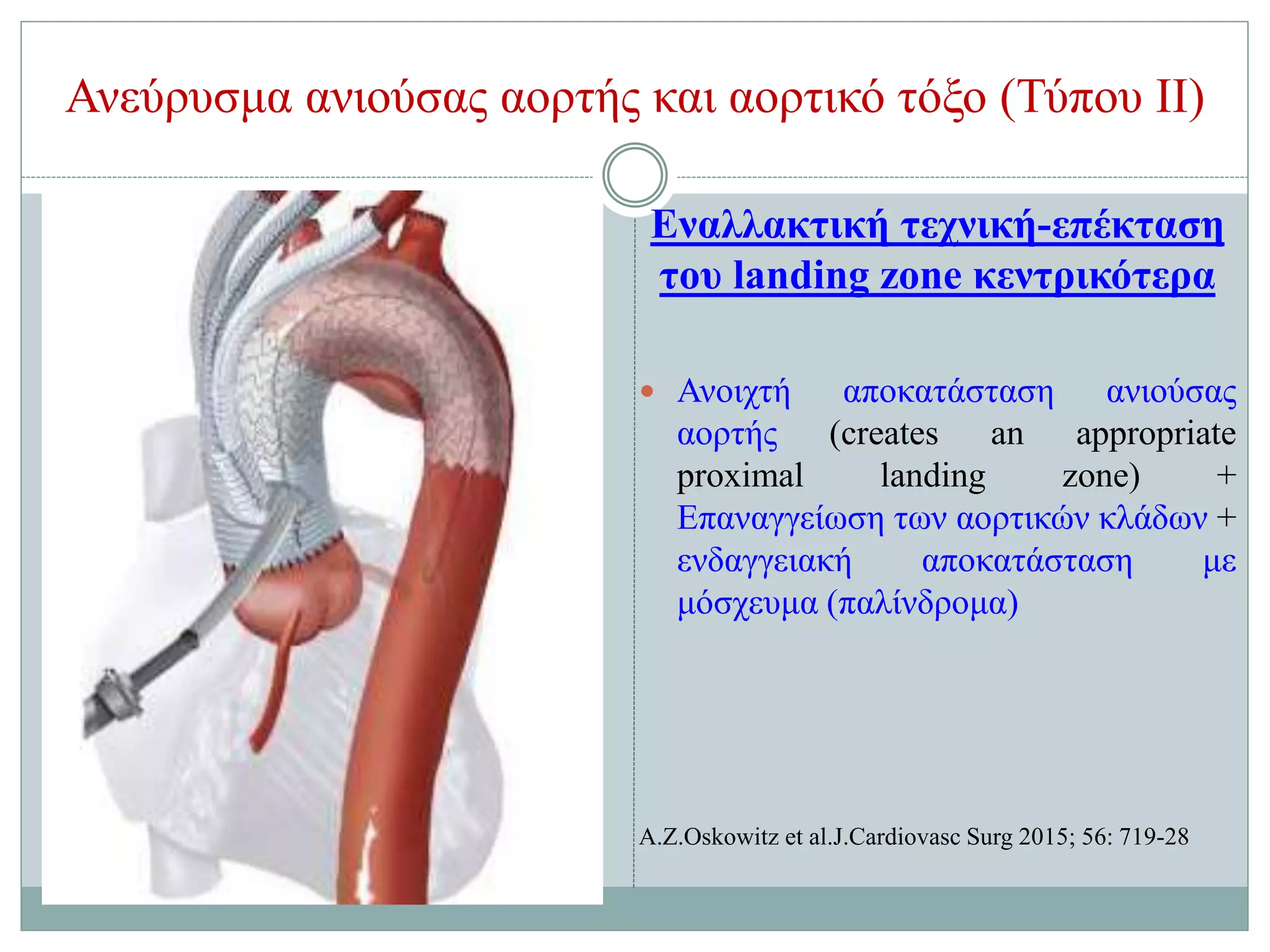 Υβριδική Αποκατάσταση Ανιούσας Αορτής και Αορτικού τόξου | PPT | Free ...