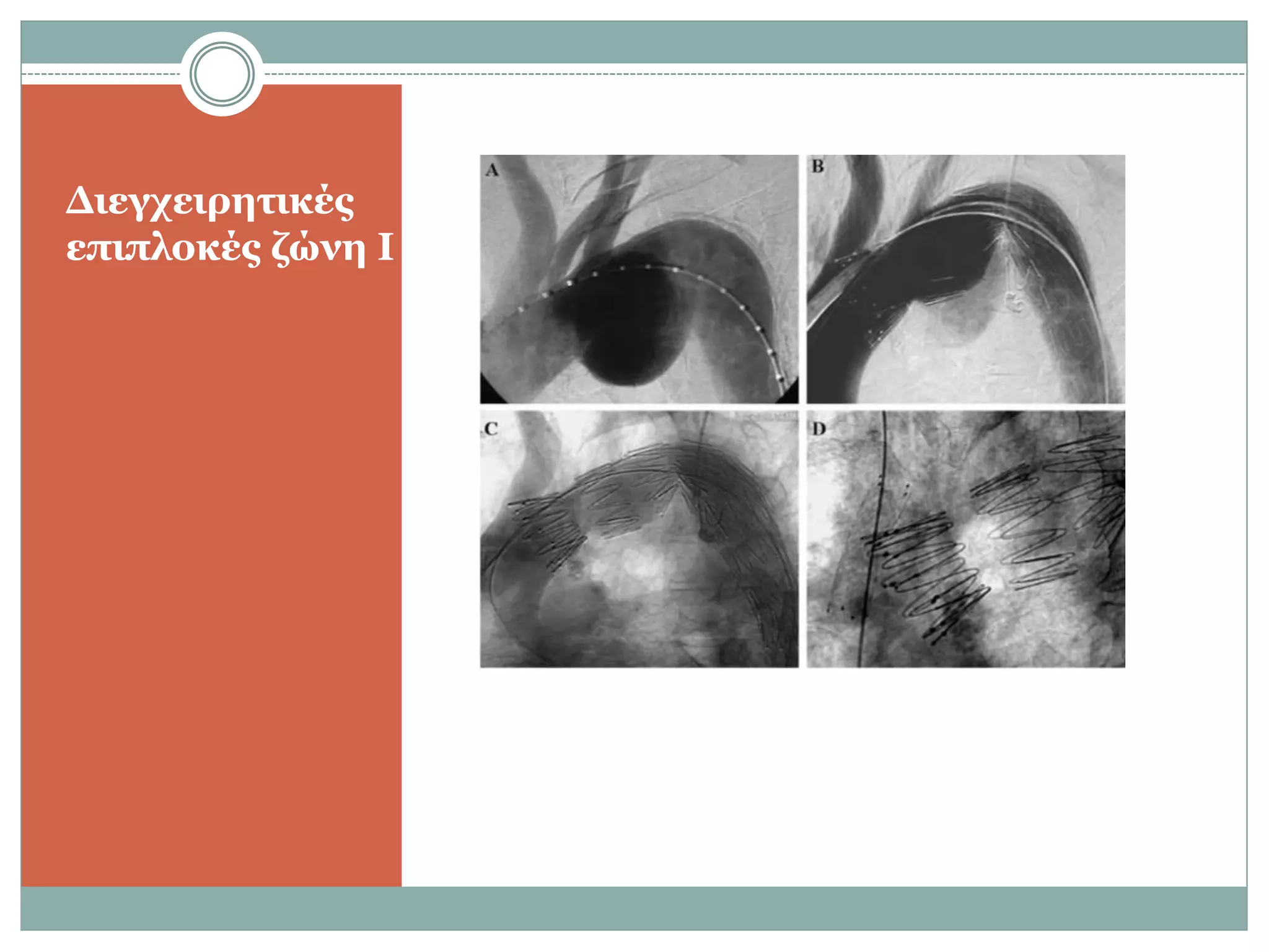 Υβριδική Αποκατάσταση Ανιούσας Αορτής και Αορτικού τόξου | PPT | Free ...
