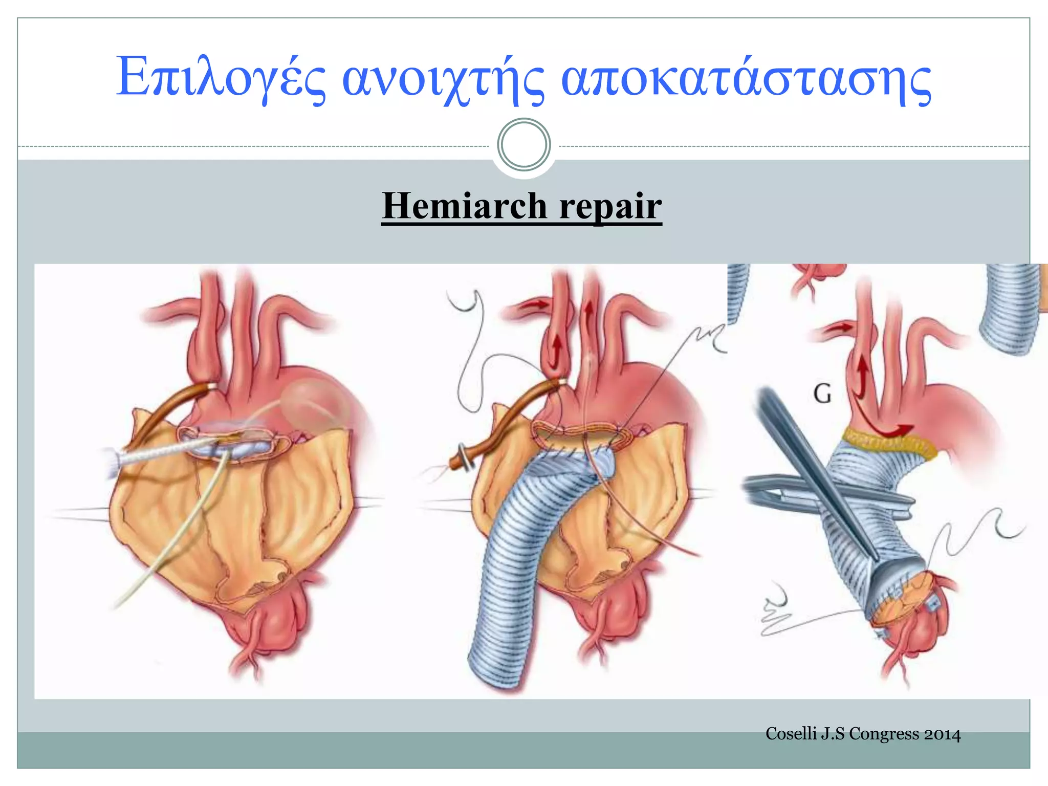 Υβριδική Αποκατάσταση Ανιούσας Αορτής και Αορτικού τόξου | PPT | Free ...