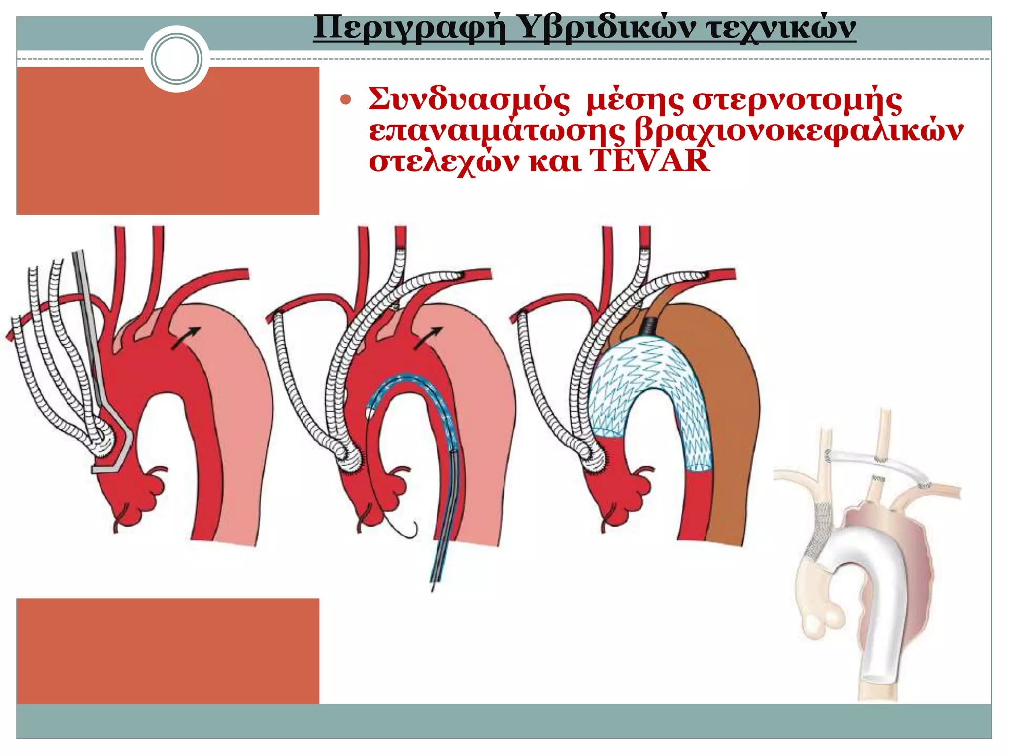 Υβριδική Αποκατάσταση Ανιούσας Αορτής και Αορτικού τόξου | PPT | Free ...