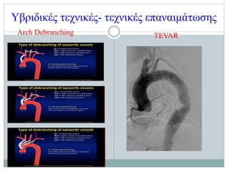 Υβριδική Αποκατάσταση Ανιούσας Αορτής και Αορτικού τόξου | PPT | Free ...