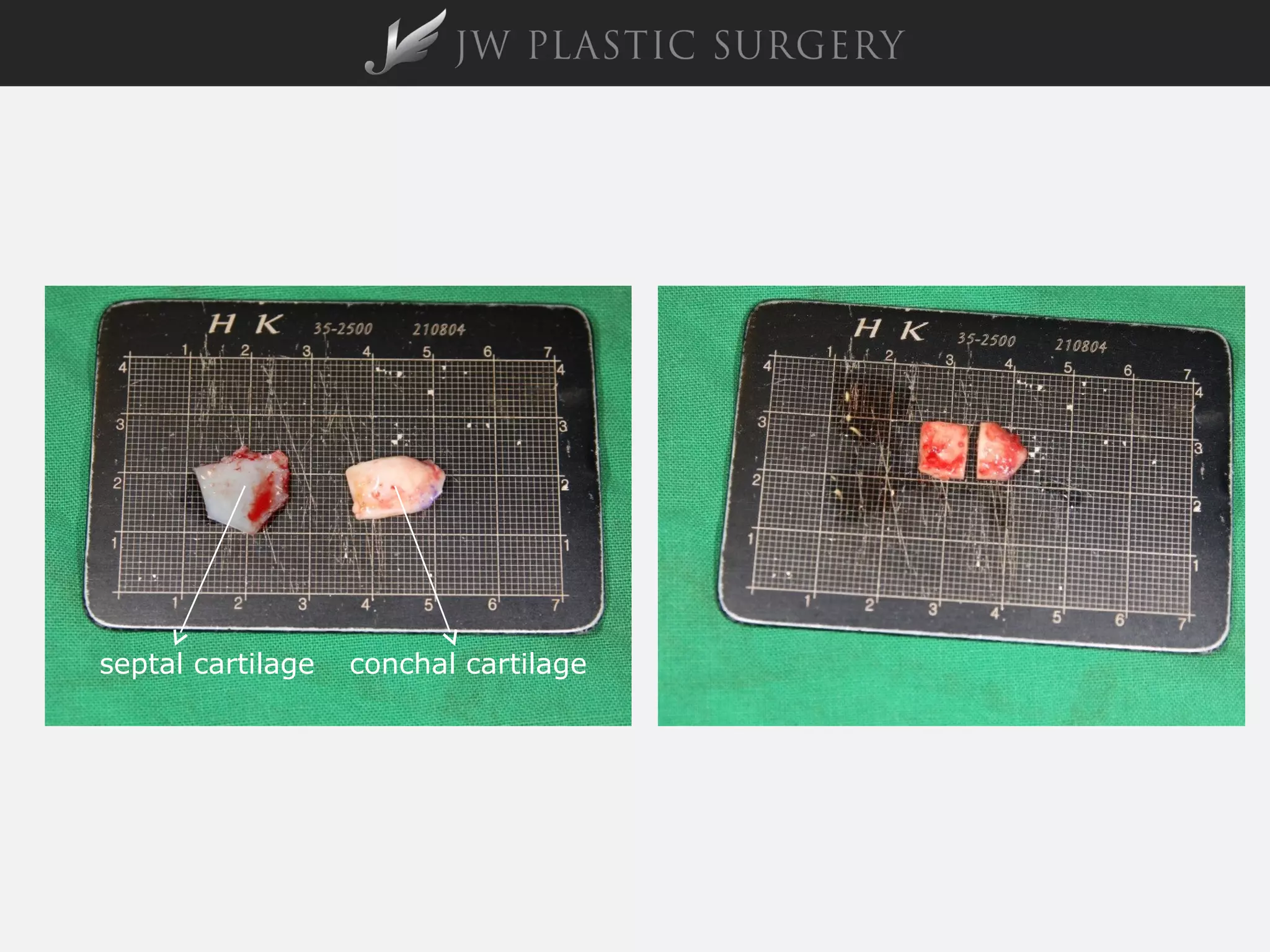 Hybrid septal extension graft for short nose correction | PPT