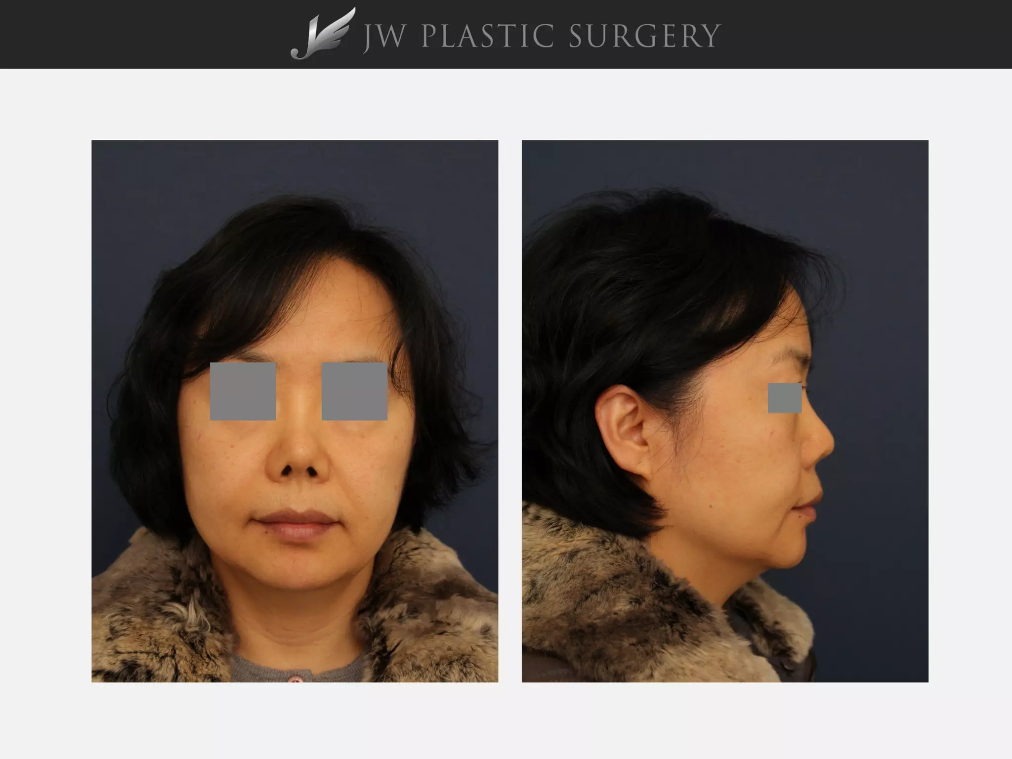 Hybrid septal extension graft for short nose correction | PPT